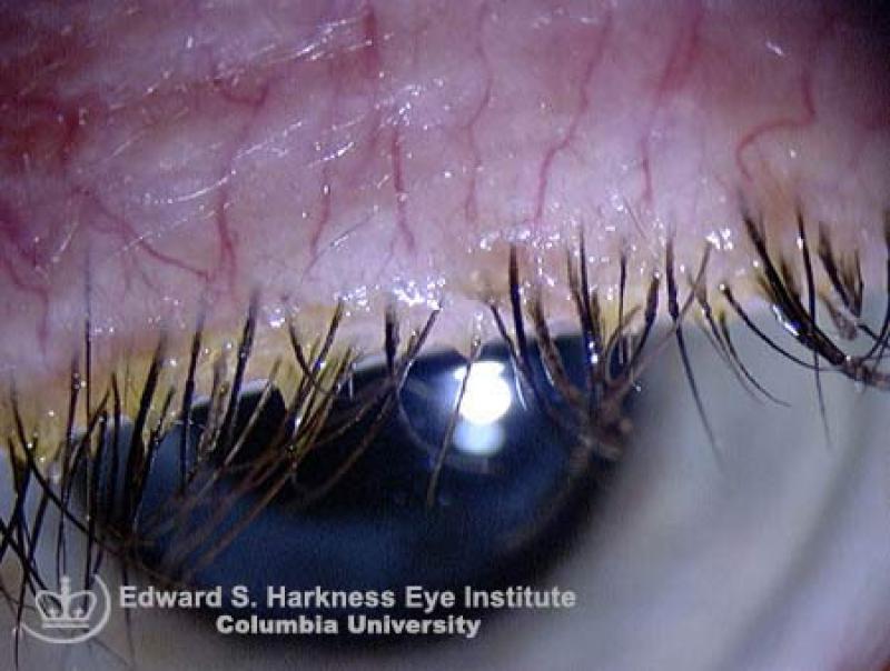 Blepharitis | Vagelos College of Physicians and Surgeons