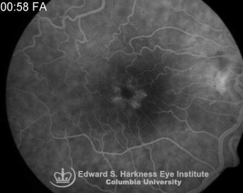 Cystoid Macular Edema | Vagelos College of Physicians and Surgeons