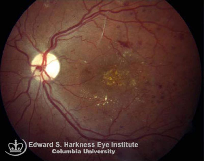 Diabetic Macular Edema (DME) | Vagelos College of Physicians and Surgeons