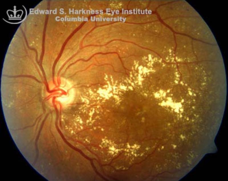 Hard Exudates | Vagelos College of Physicians and Surgeons