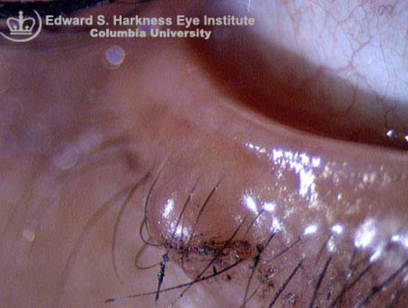 Hydrocystoma | Vagelos College of Physicians and Surgeons