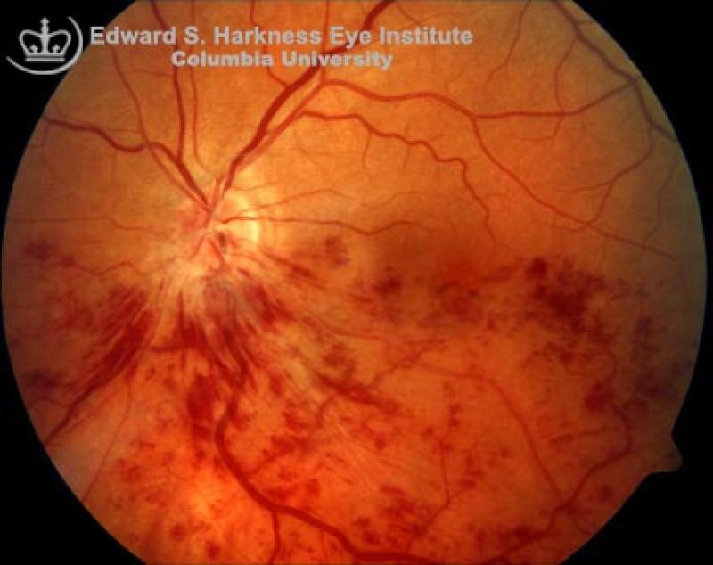 Inferior Hemicentral Retinal Vein Occlusion | Vagelos College of ...