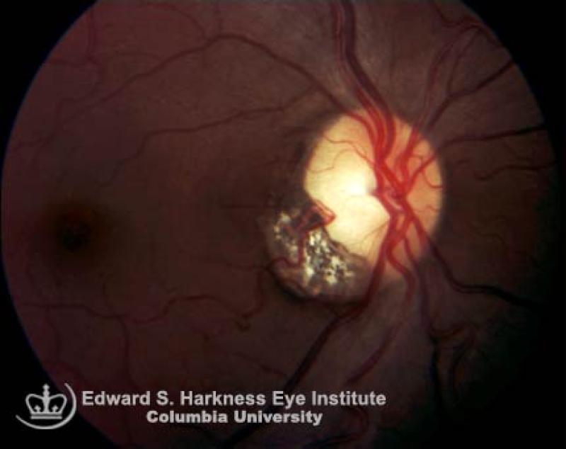 Optic Nerve Coloboma | Vagelos College of Physicians and Surgeons