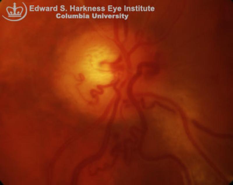 Optociliary Shunt | Vagelos College of Physicians and Surgeons