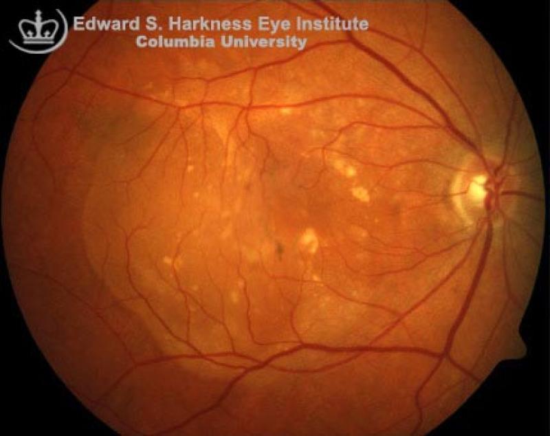 Pigment Epithelium Detachment | Vagelos College of Physicians and Surgeons