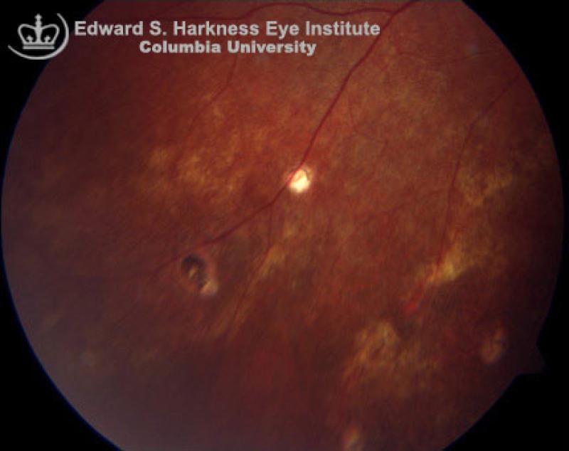 Presumed Ocular Histoplasmosis Syndrome (POHS) | Vagelos College of ...