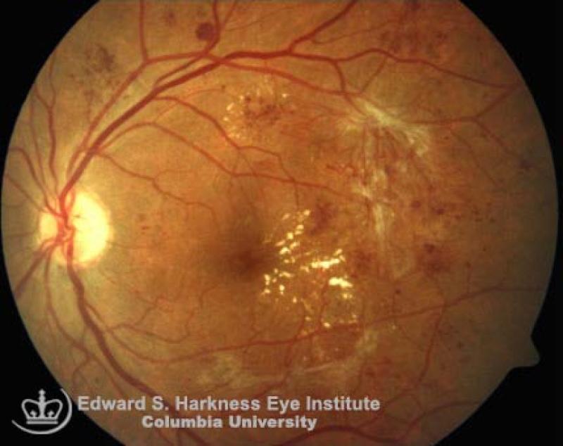 Proliferative Diabetic Retinopathy (PDR) | Vagelos College of ...