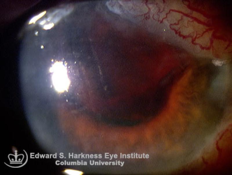 Suprachoroidal and Vitreous Hemorrhage Post ECCE | Vagelos College of ...