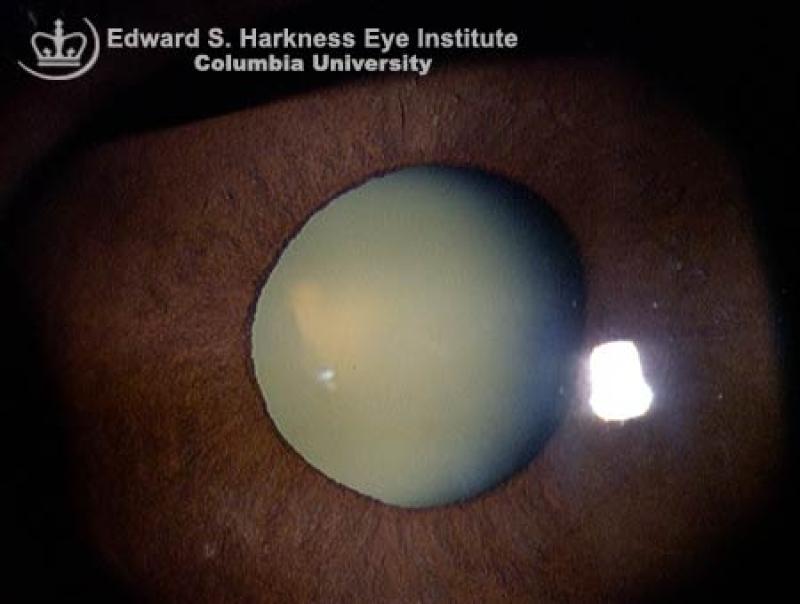 Phacolytic Glaucoma | Vagelos College of Physicians and Surgeons