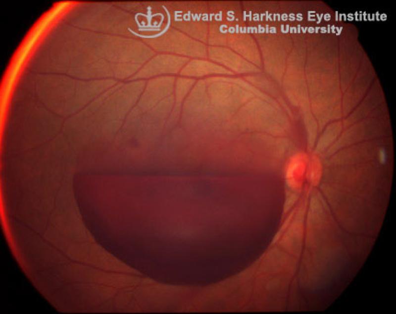 Preretinal Hemorrhage | Vagelos College of Physicians and Surgeons