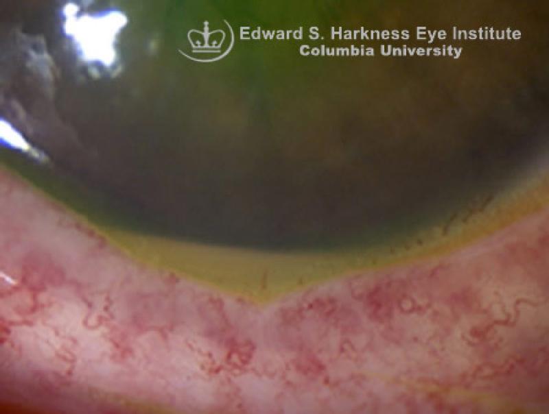 Anterior Uveitis | Vagelos College of Physicians and Surgeons