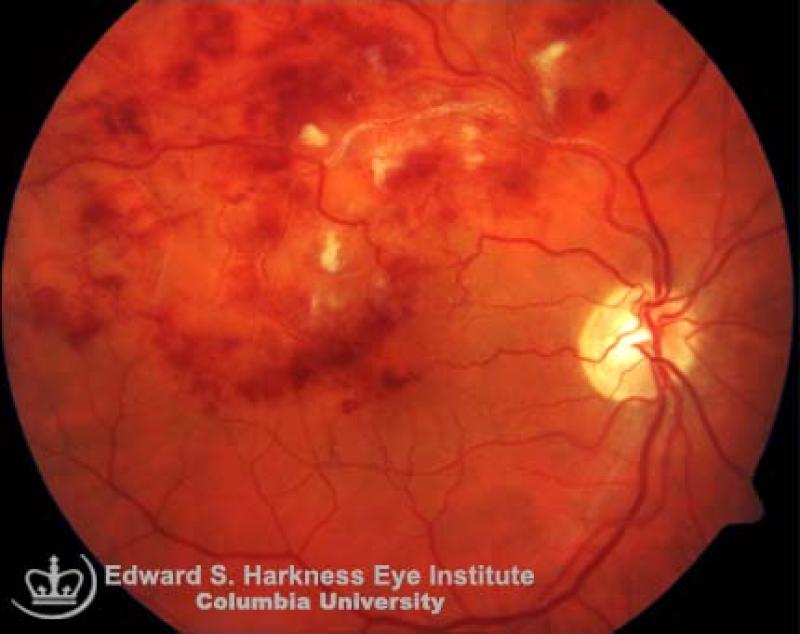 Branch Retinal Vein Occlusion (BRVO) | Vagelos College of Physicians ...