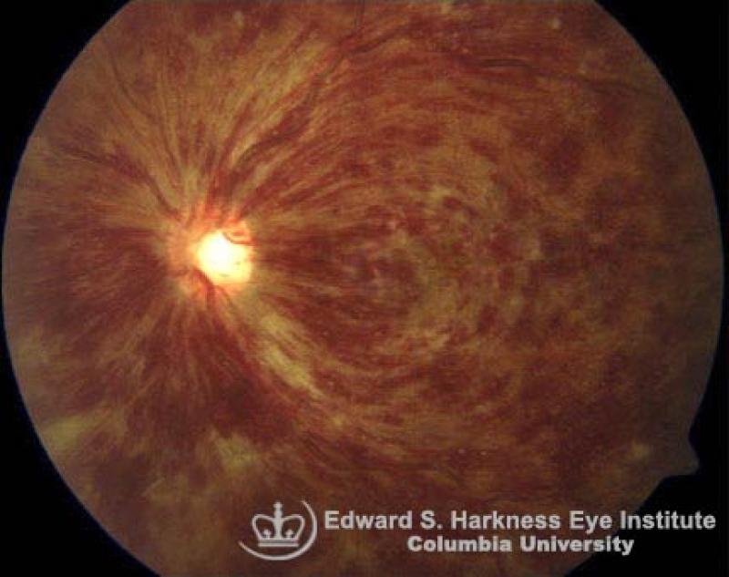Central Retinal Vein Occlusion | Vagelos College of Physicians and Surgeons