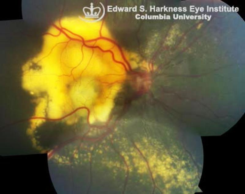 Coats' Disease | Vagelos College of Physicians and Surgeons