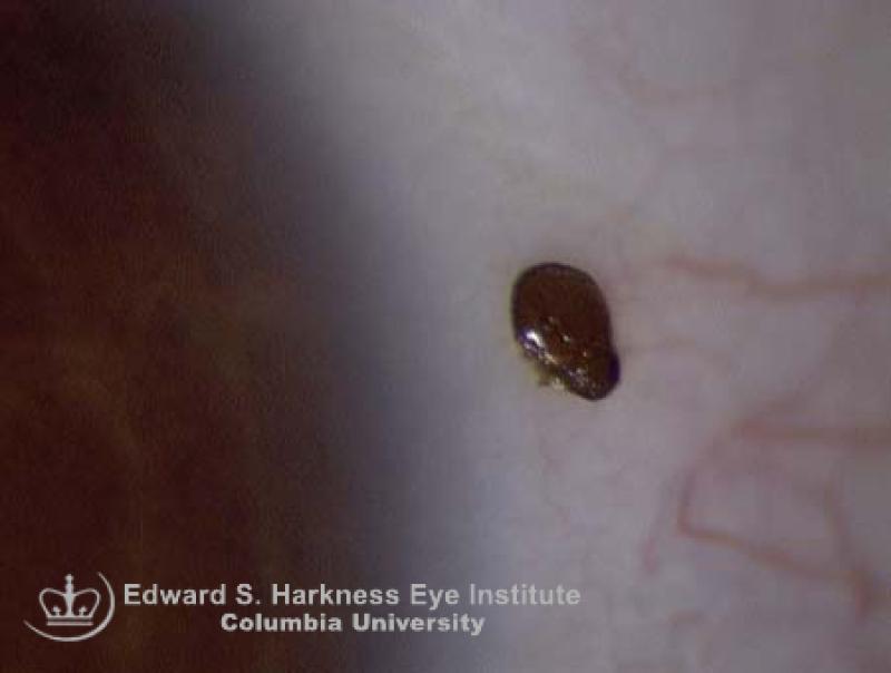 Conjunctival Foreign Body | Vagelos College of Physicians and Surgeons