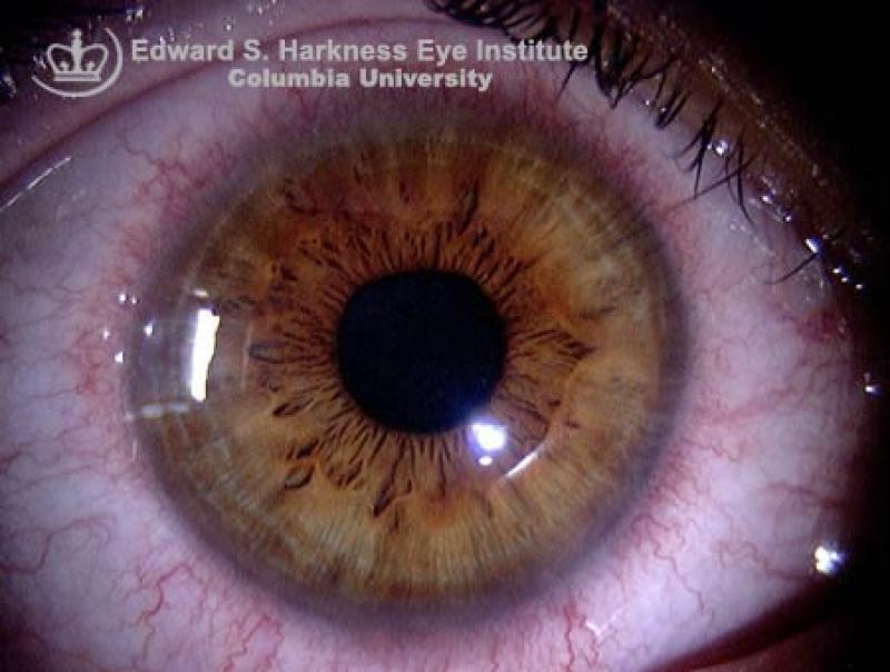 Corneal Neovascularization | Vagelos College of Physicians and Surgeons