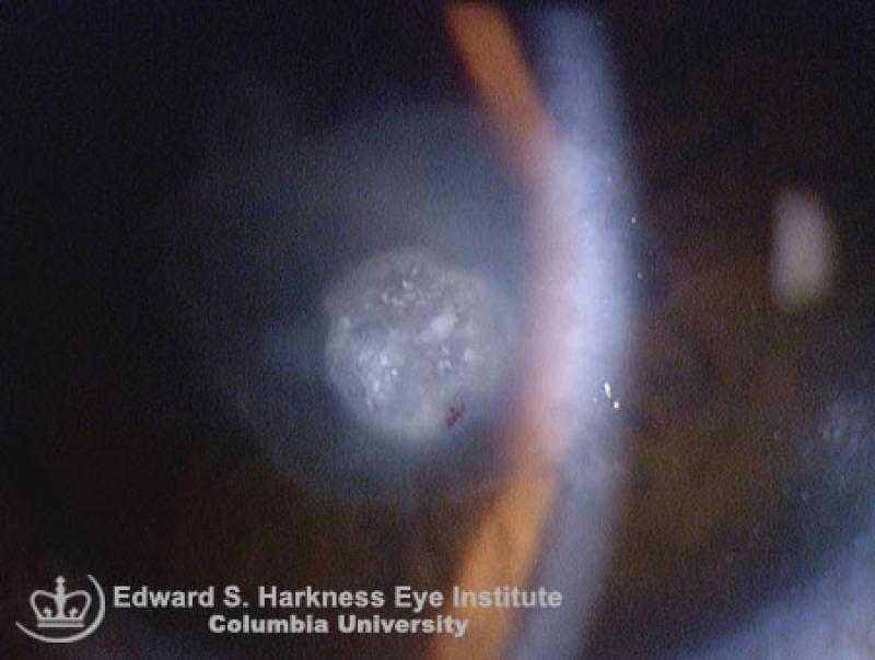 Corneal Perforation | Vagelos College of Physicians and Surgeons