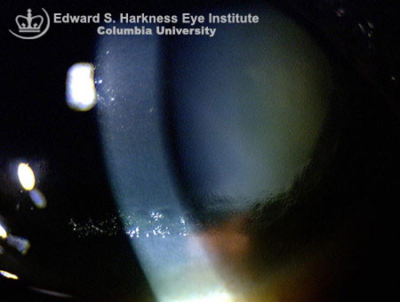 Furrow Degeneration | Vagelos College of Physicians and Surgeons