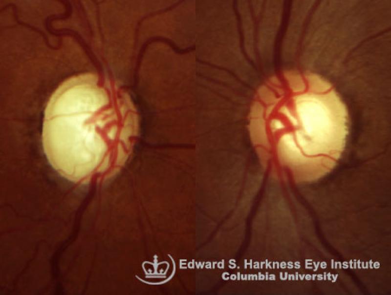 Glaucomatous Optic Nerve | Vagelos College of Physicians and Surgeons