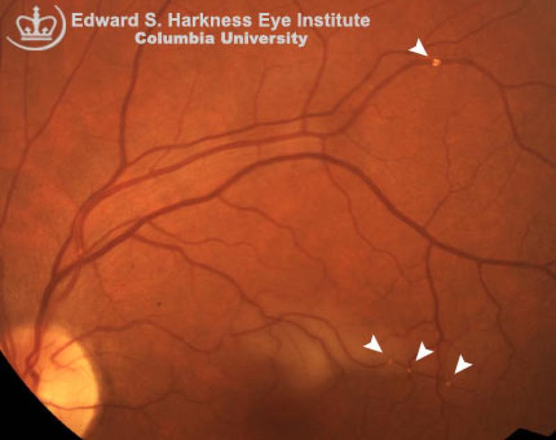 Hollenhorst Plaques | Vagelos College of Physicians and Surgeons