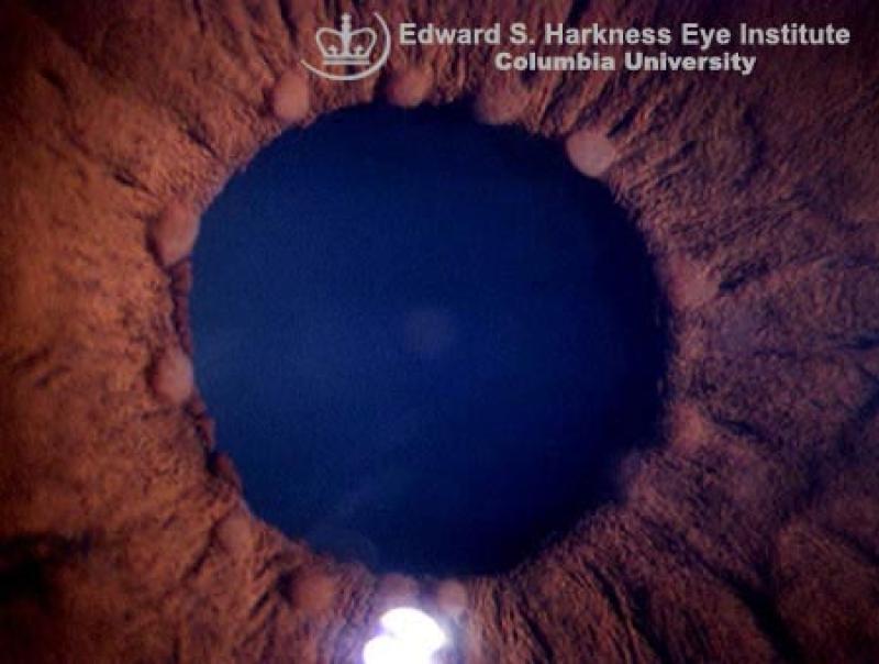 Koeppe's Nodules | Vagelos College of Physicians and Surgeons