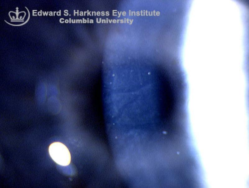 Macrostriae | Vagelos College of Physicians and Surgeons