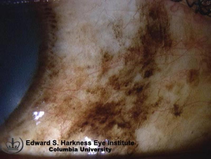 Primary Acquired Melanosis (PAM) | Vagelos College of Physicians and ...