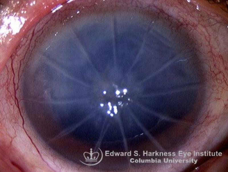 Radial Keratotomy Complication | Vagelos College of Physicians and Surgeons