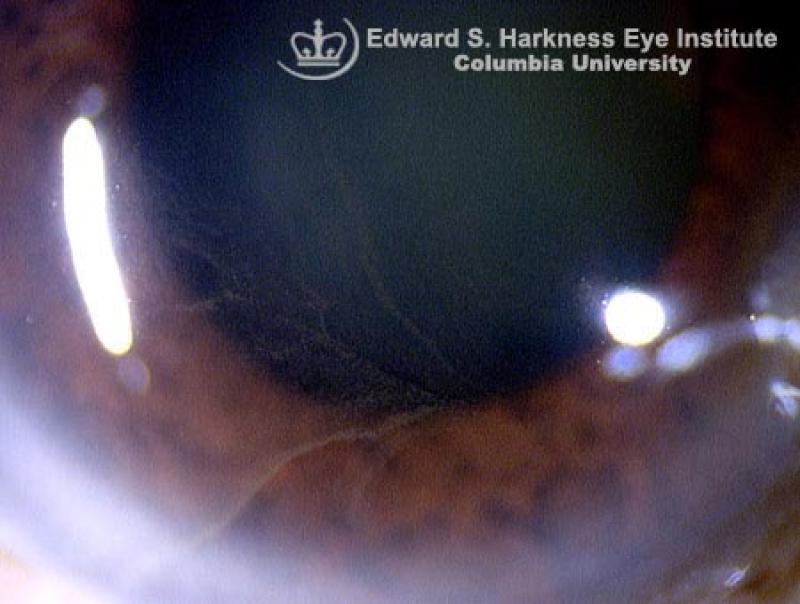 Vortex Keratopathy | Vagelos College of Physicians and Surgeons